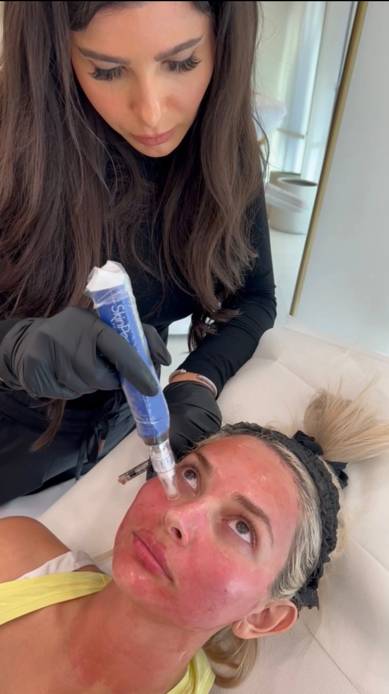Microneedling + PRF injection - 1 session | Iconique Medical Aesthetics ...