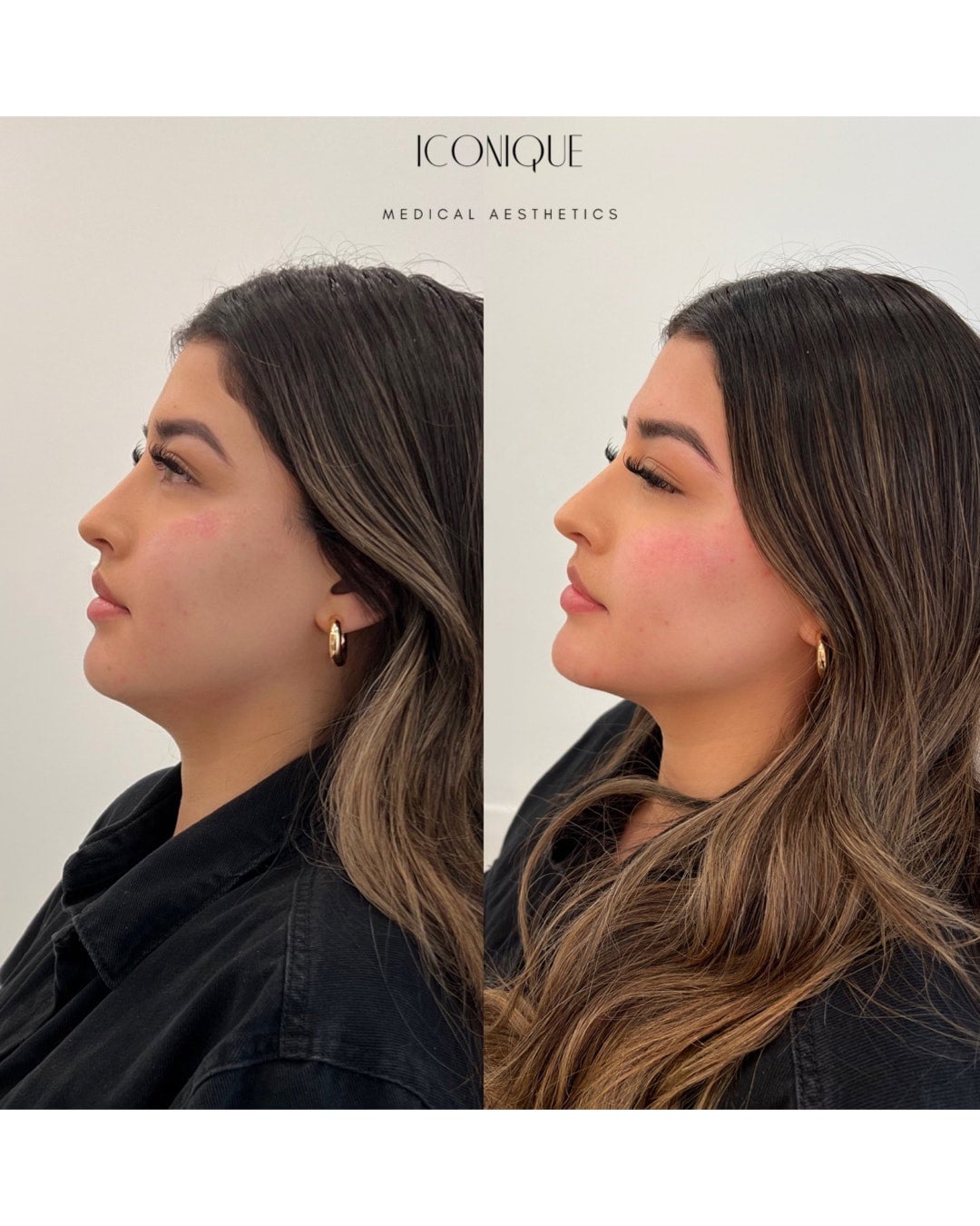Iconique Lift | Iconique Medical Aesthetics | OC Med Spa