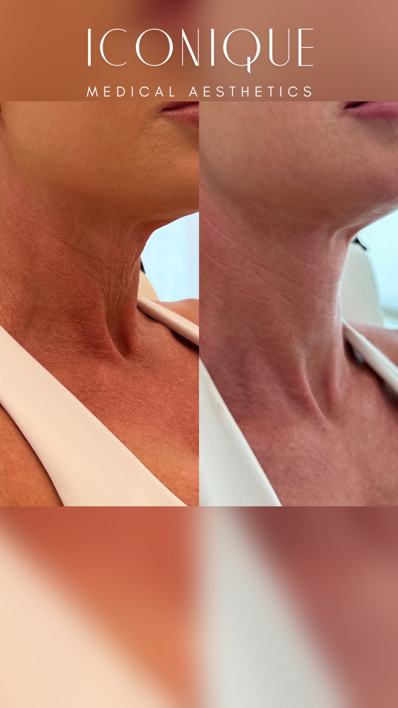Skintyte ( 5 session) | Iconique Medical Aesthetics | OC Med Spa