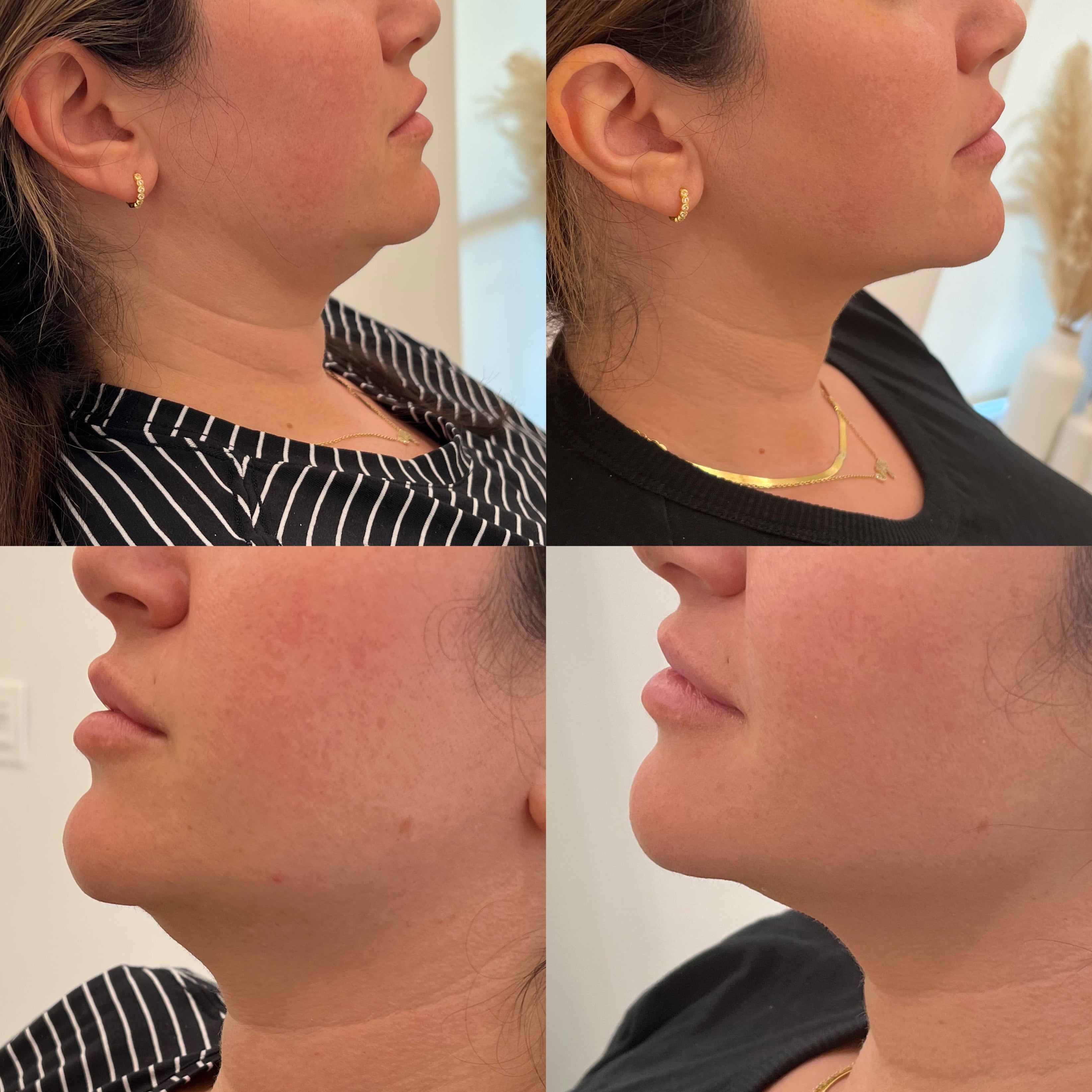 2 Vials Kybella | Iconique Medical Aesthetics | OC Med Spa