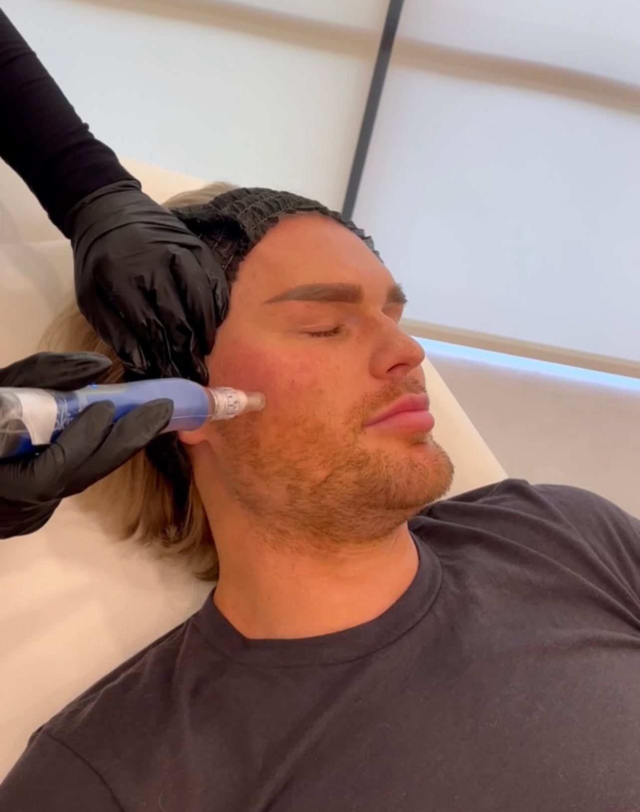 Microneedling + PRF - 3 sessions | Iconique Medical Aesthetics | OC Med Spa