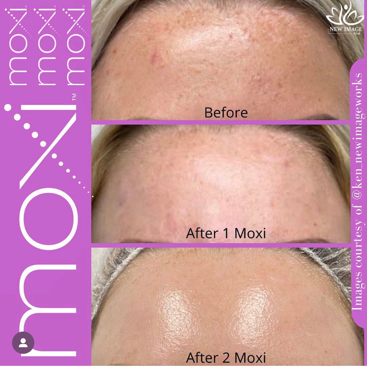 MOXI Laser (Face) 1 Session | Iconique Medical Aesthetics | OC Med Spa