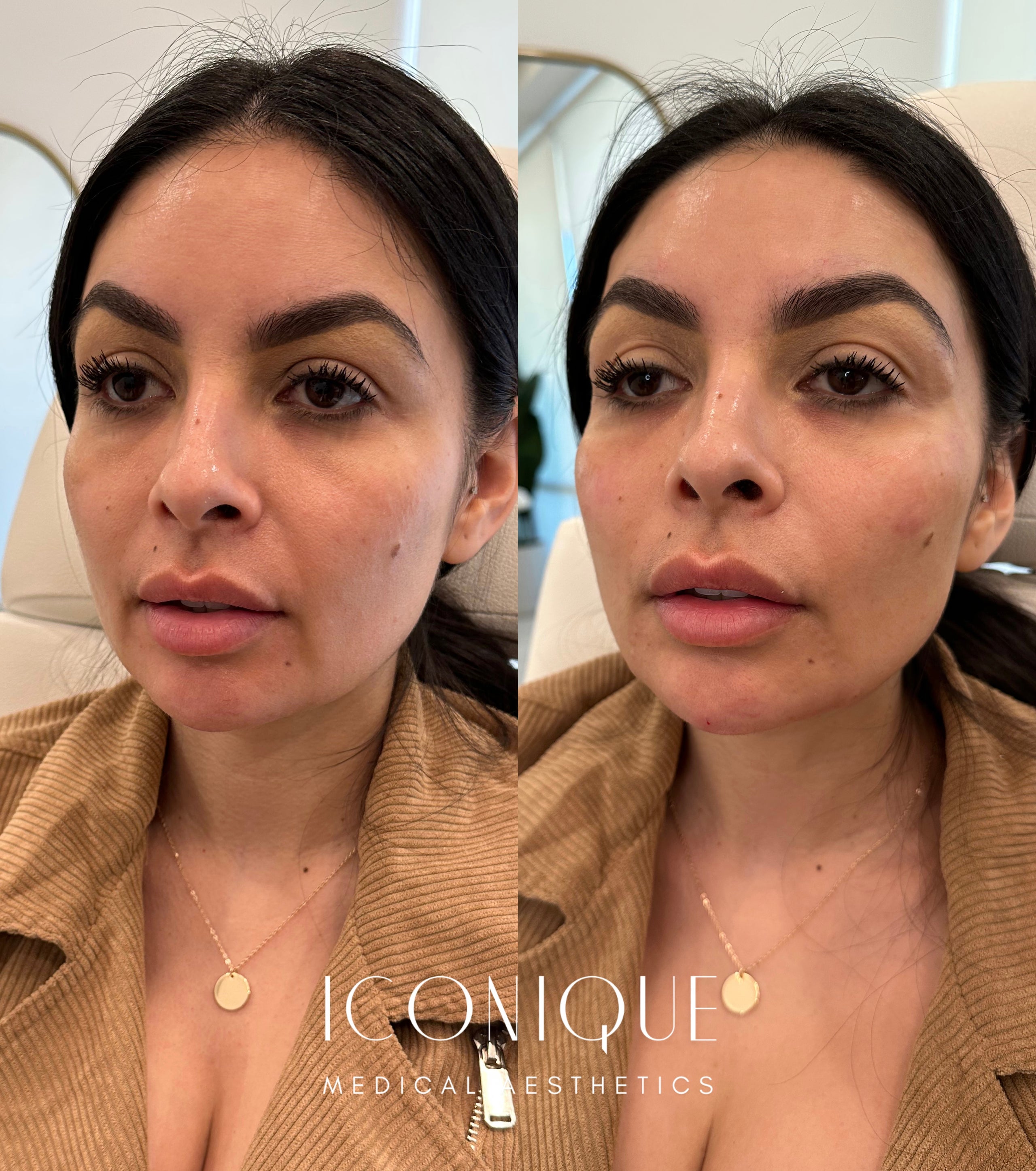 3 PRF GEL injections - 3 sessions | Iconique Medical Aesthetics | OC ...